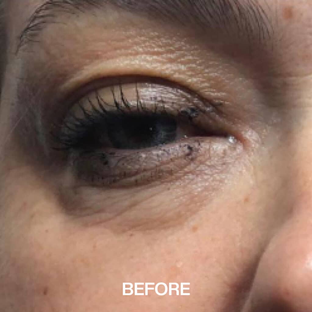 Eye bags treatment Liverpool | Endolift | Eye Bags Removal