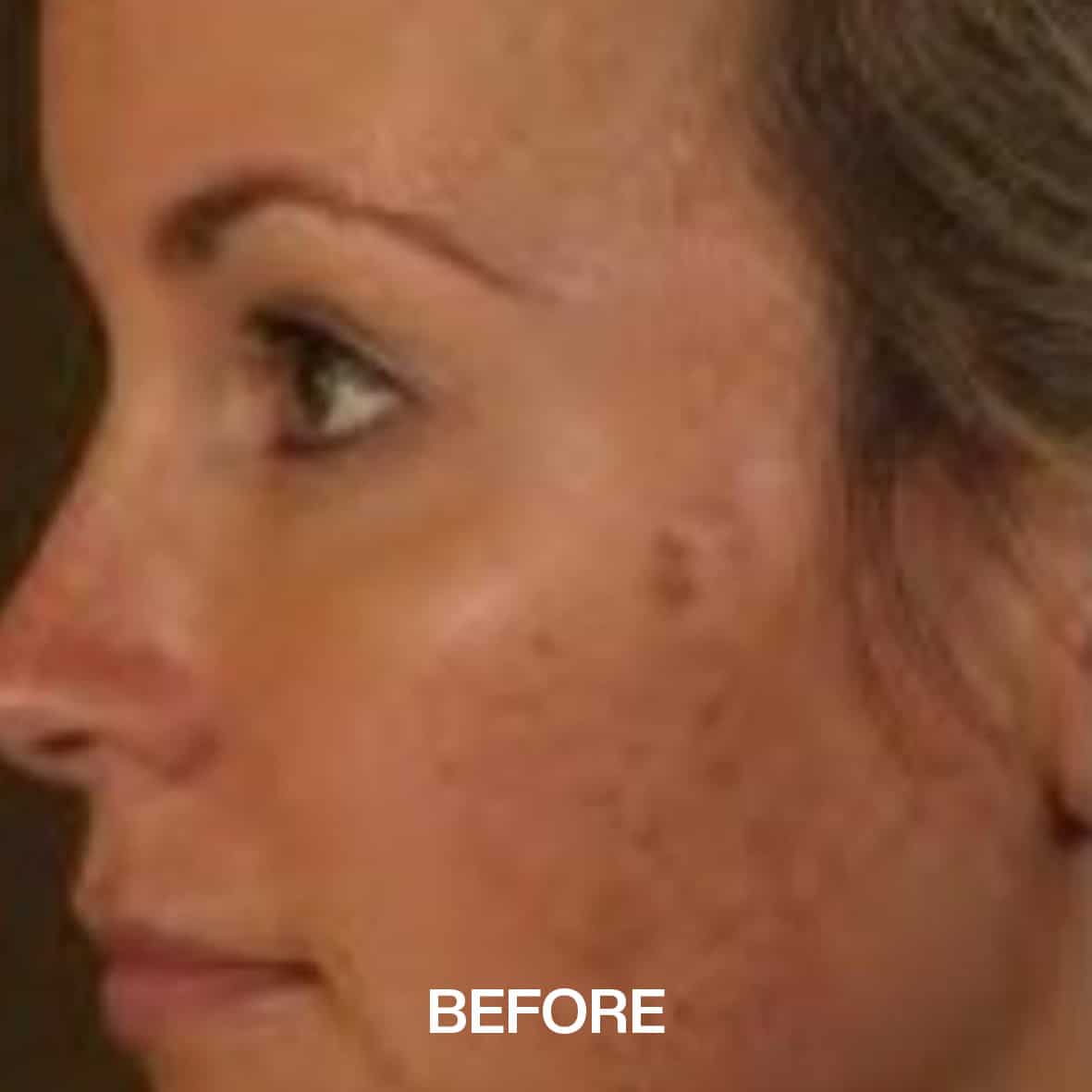 Vampire Face Lift Liverpool | PRP facial before and after