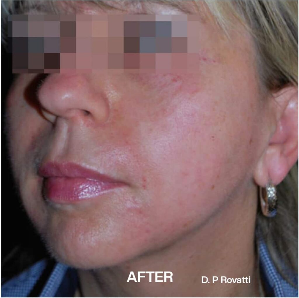 Tighten Sagging Jowls Liverpool | Sagging jowls treatment