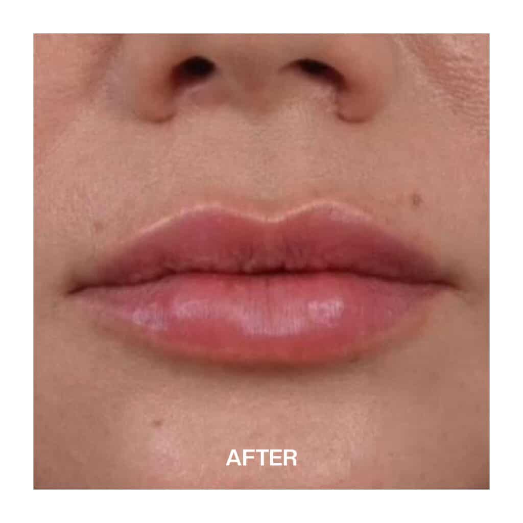 Dissolving lip filler Liverpool | Lip filler dissolving