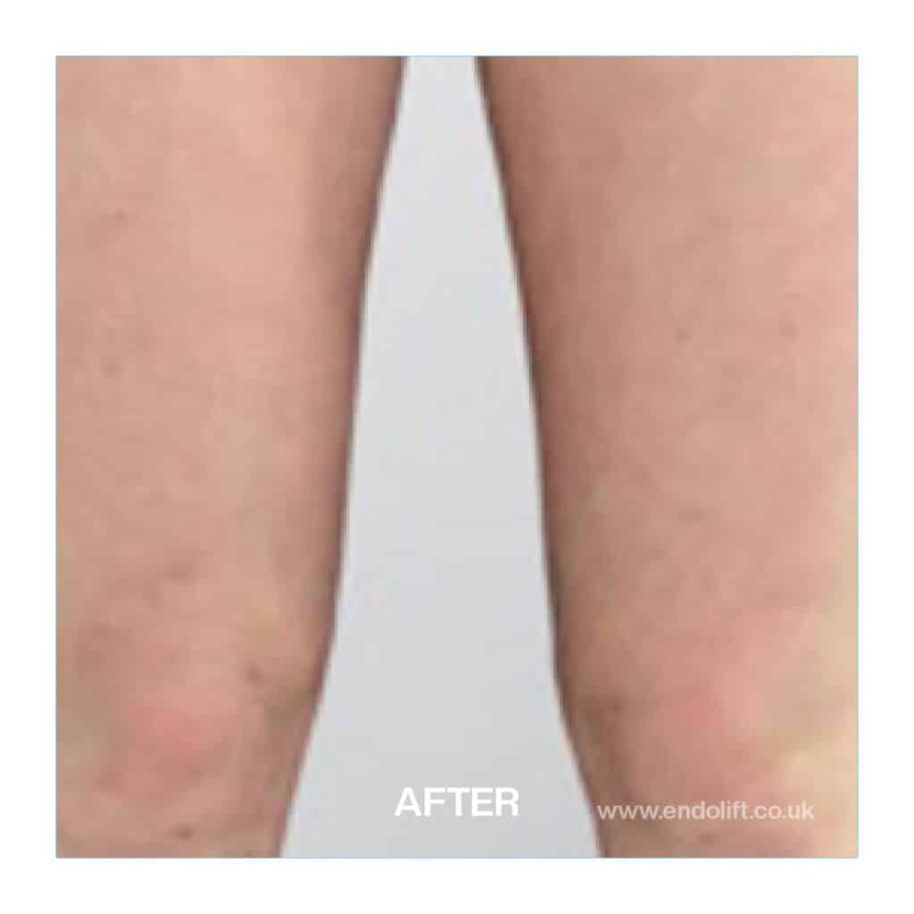 Inner Thigh Lift Liverpool | Skin tightening | Inner thigh