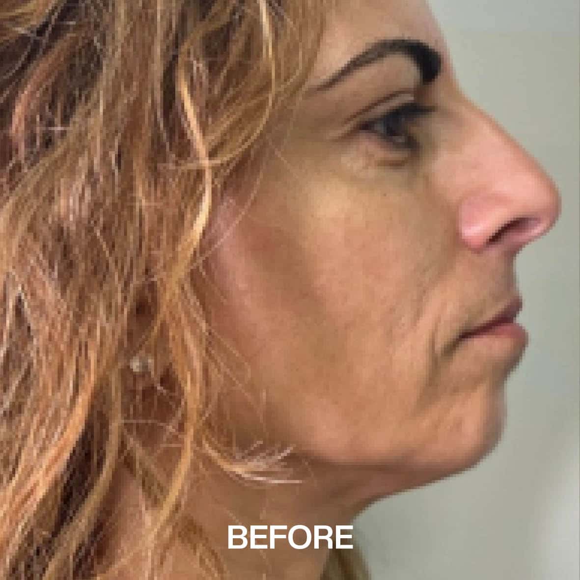 ENDOLIFT FOR BODY | ULTIMATE BODY SKIN TIGHTENING