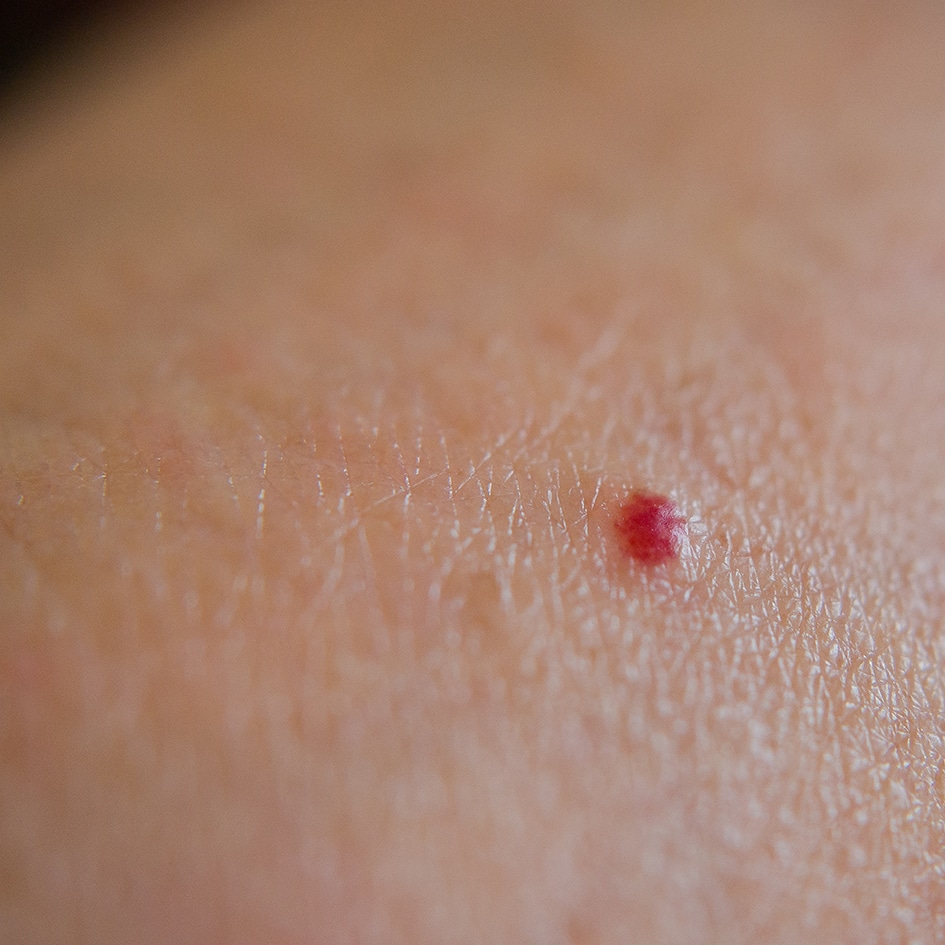 Blood Spot Removal | Cherry Angioma Treatment Prices 2023