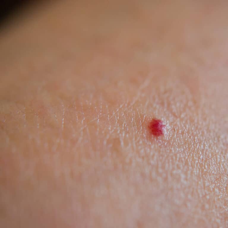 Blood Spot Removal | Cherry Angioma Treatment Prices 2023