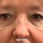 NEOGEN TREATMENT | CUTTING EDGE PLASMA TREATMENT