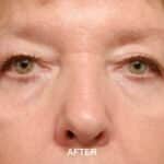 NEOGEN TREATMENT | CUTTING EDGE PLASMA TREATMENT