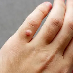 WARTS REMOVAL | SKIN CARE TREATMENTS LIVERPOOL