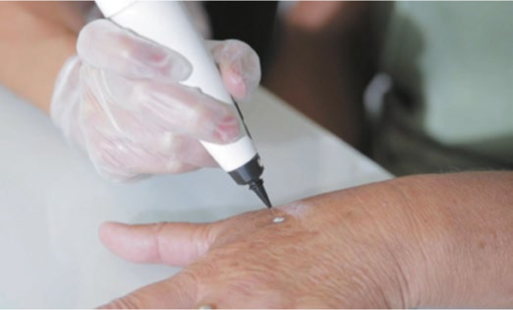 CRYOPEN™ | CRYOTHERAPY | MOLE, WART, SKIN TAG REMOVAL