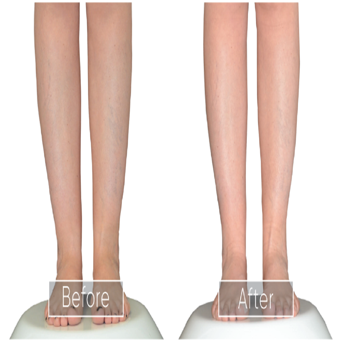 ENDOLIFT FOR BODY | ULTIMATE BODY SKIN TIGHTENING