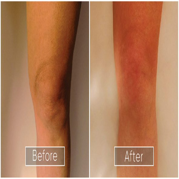 ENDOLIFT FOR BODY | ULTIMATE BODY SKIN TIGHTENING