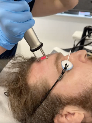 COOL LASER FOR ACNE SCARS | SKIN RESURFACING LIVERPOOL