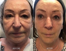 SPRING THREAD LIFT | PERMANENT FACELIFT | LIVERPOOL