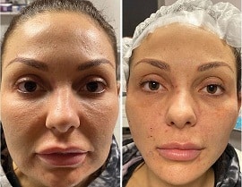 SPRING THREAD LIFT | PERMANENT FACELIFT | LIVERPOOL