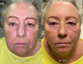 SPRING THREAD LIFT | PERMANENT FACELIFT | LIVERPOOL