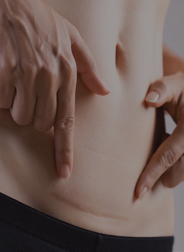 C-Section SCAR REVISION | THE ROYAL LIVER BUILDING LIVERPOOL